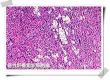 Malignt fibröst histiocytom - Sidor [1] - World uppslagsverk kunskap